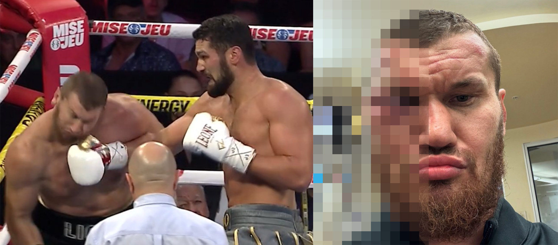 Boxer's Eye Balloons After Epic Bout
